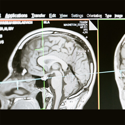 Le Diagnostic Sclérose en Plaques (SEP) - Ensemble Pour La Vie